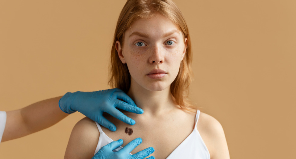 Día del lunar: ¿Cómo identificar un lunar peligroso?